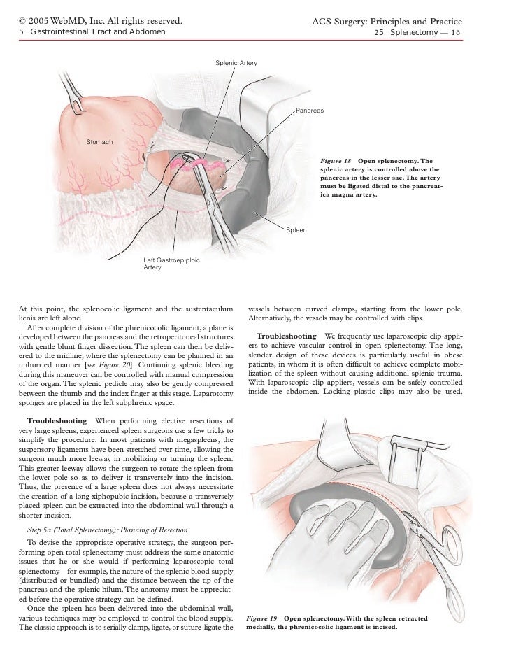 Acs0525 splenectomy-2005