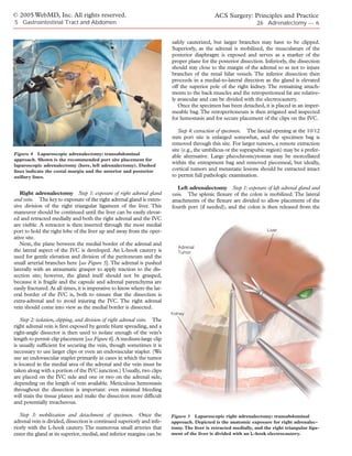 Acs0526 Adrenalectomy 2005 | PDF