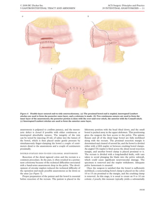Acs0529 Intestinal Anastomosis 2008 | PDF