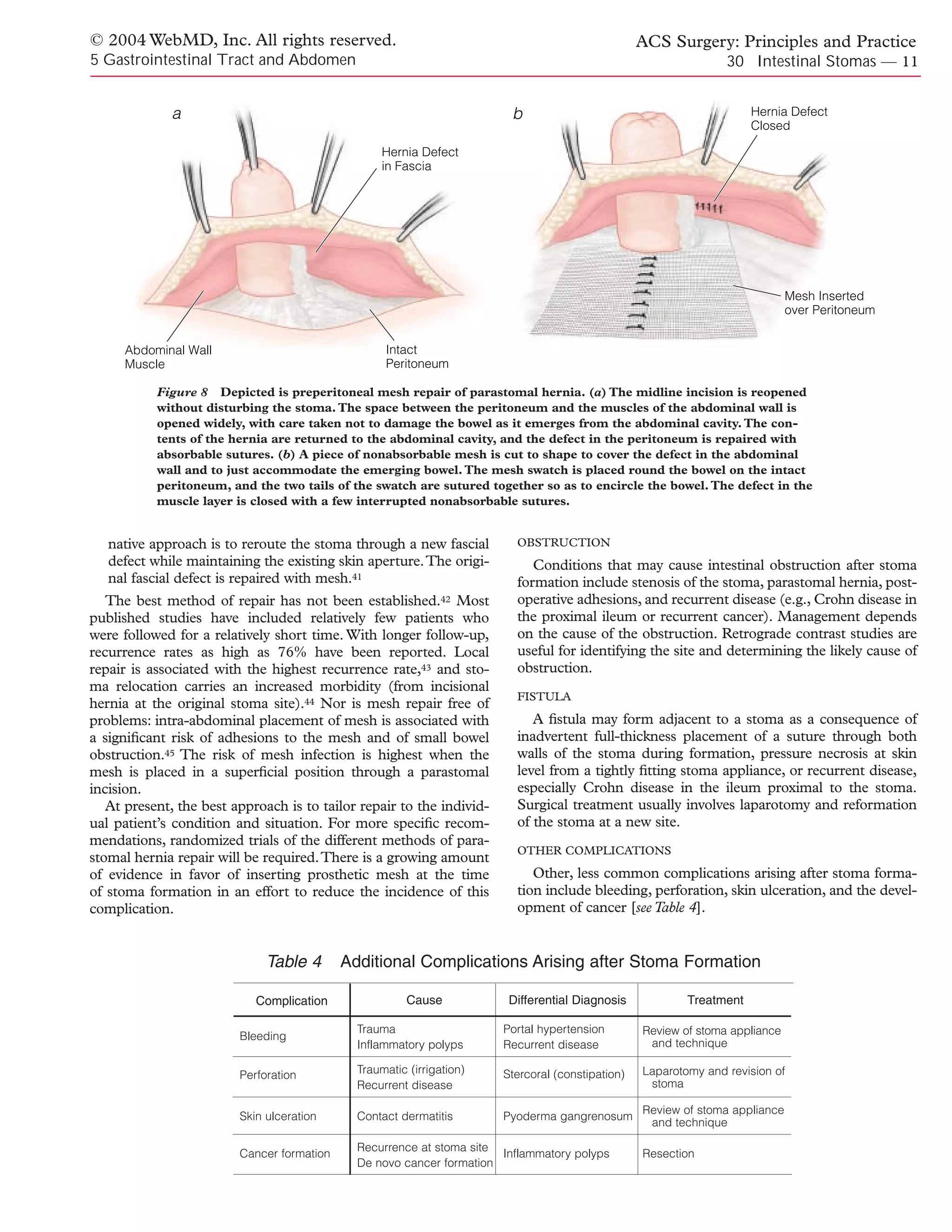 Acs0530 Intestinal Stomas 2004 | PDF