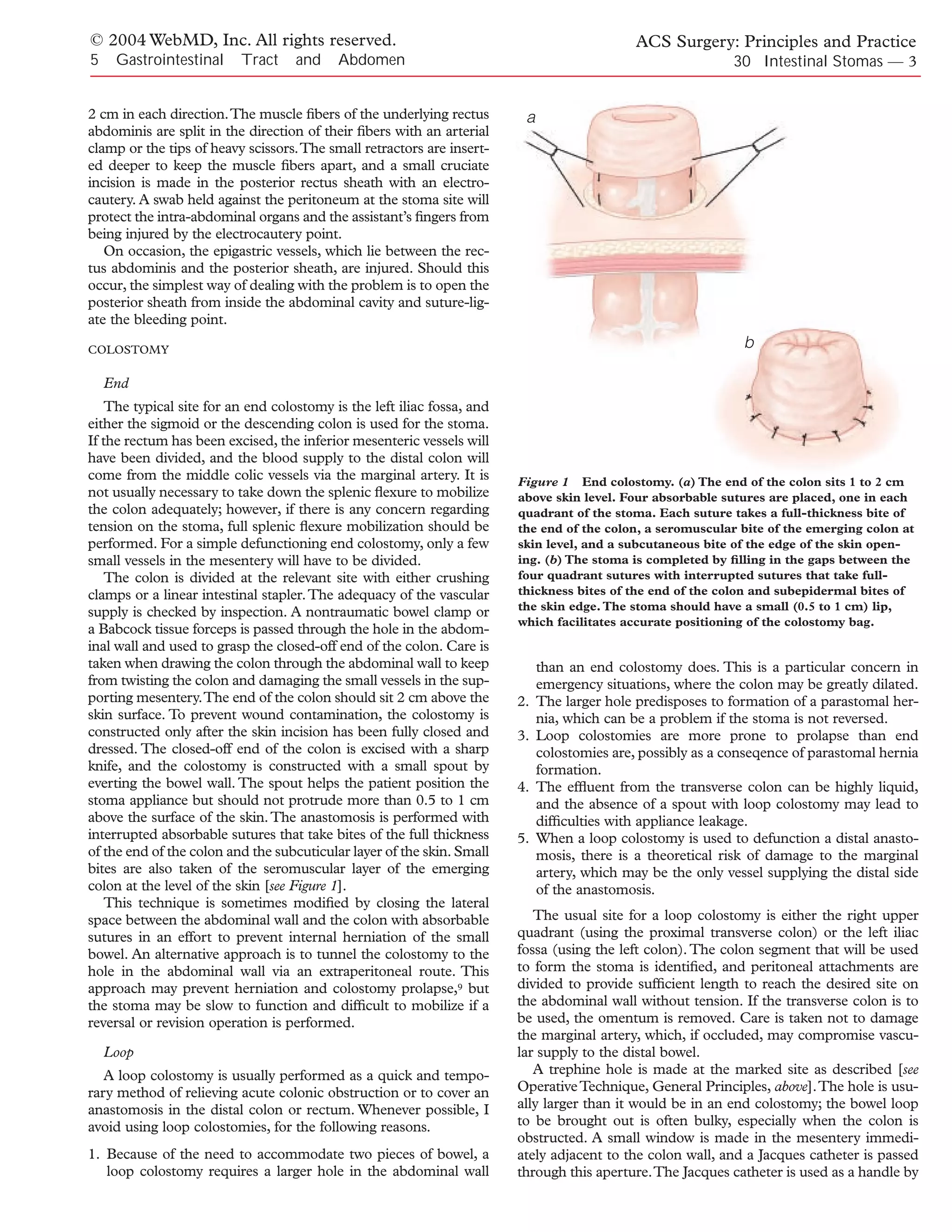 Acs0530 Intestinal Stomas 2004 | PDF