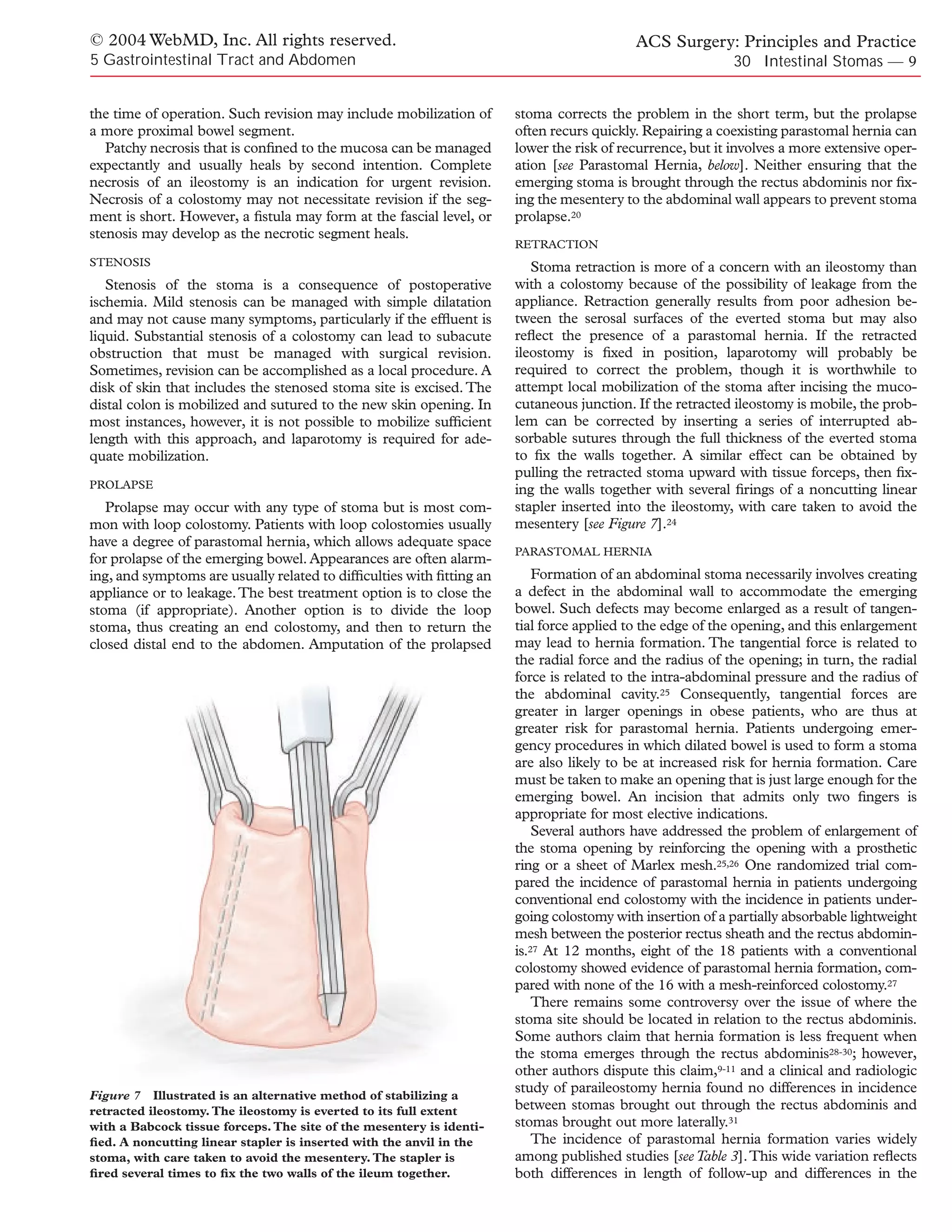 Acs0530 Intestinal Stomas 2004 | PDF
