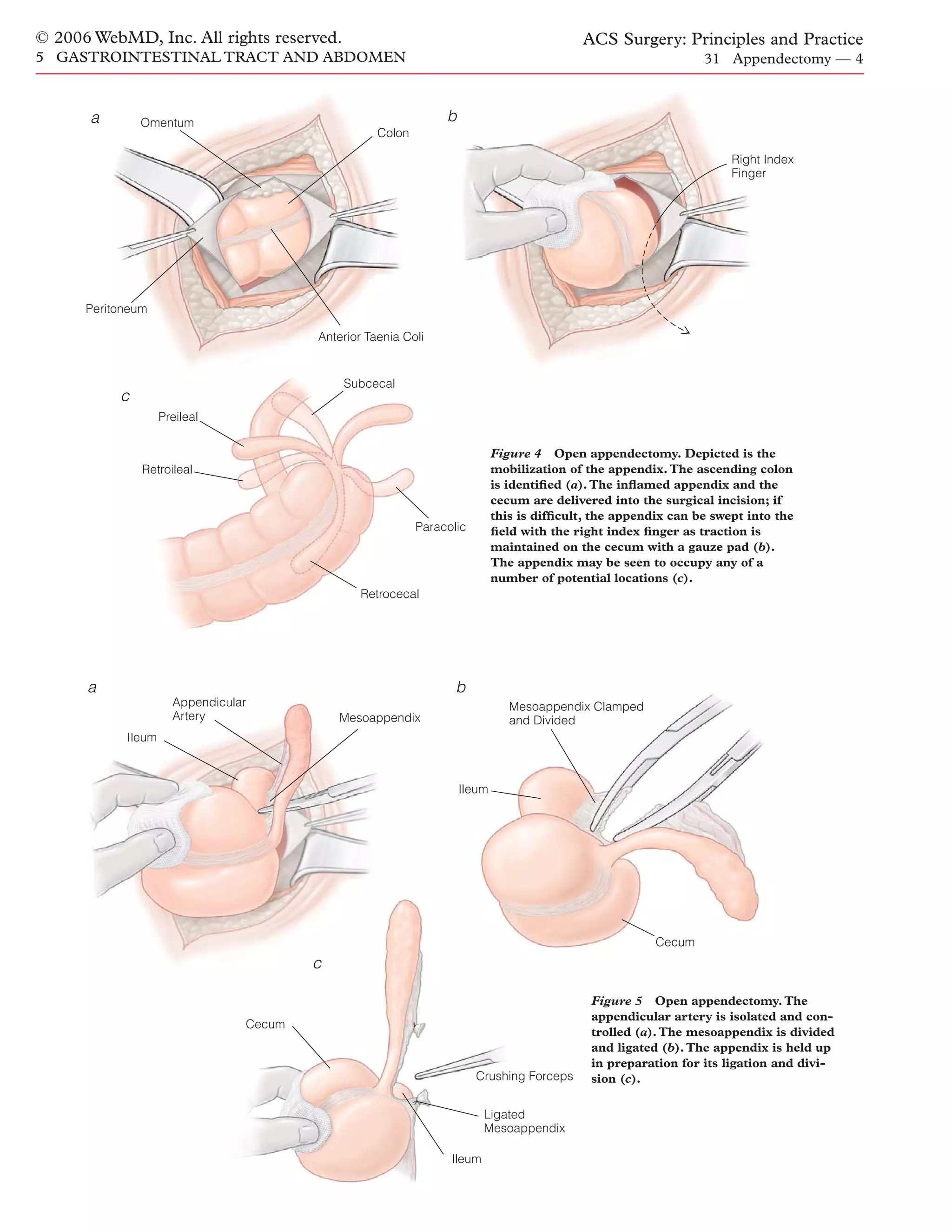 Acs0531 Appendectomy 2006 | PDF