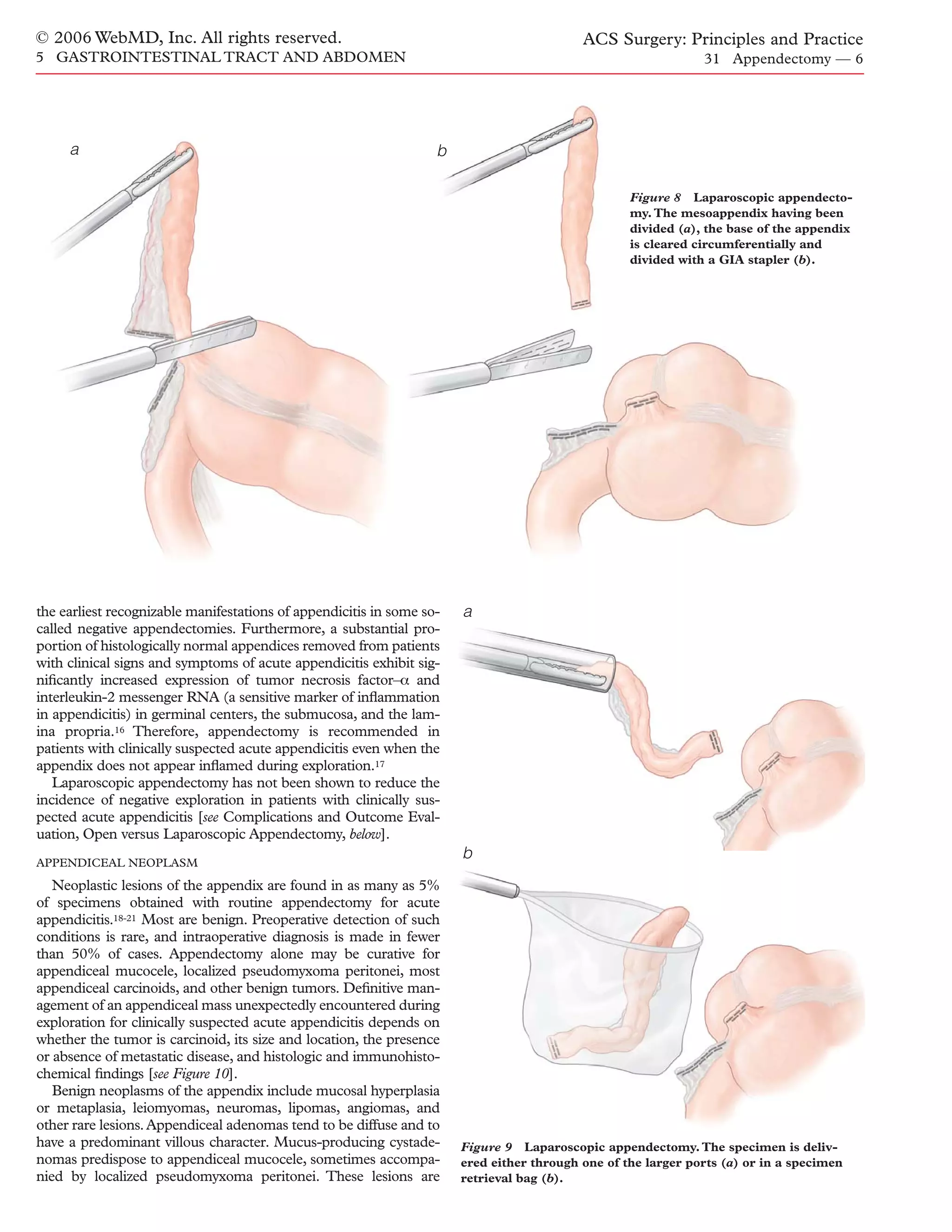 Acs0531 Appendectomy 2006 | PDF