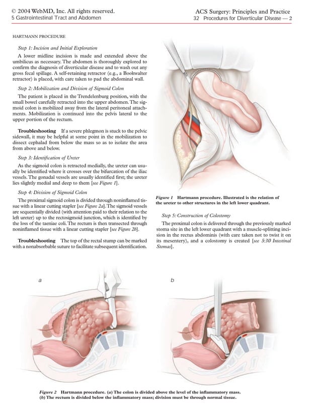 Acs0532 Procedures For Diverticular Disease 2004 | PDF | Digestive Disorders | Diseases and ...