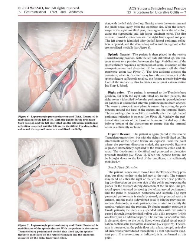 Acs0533 The Surgical Management Of Ulcerative Colitis 2004 | PDF ...