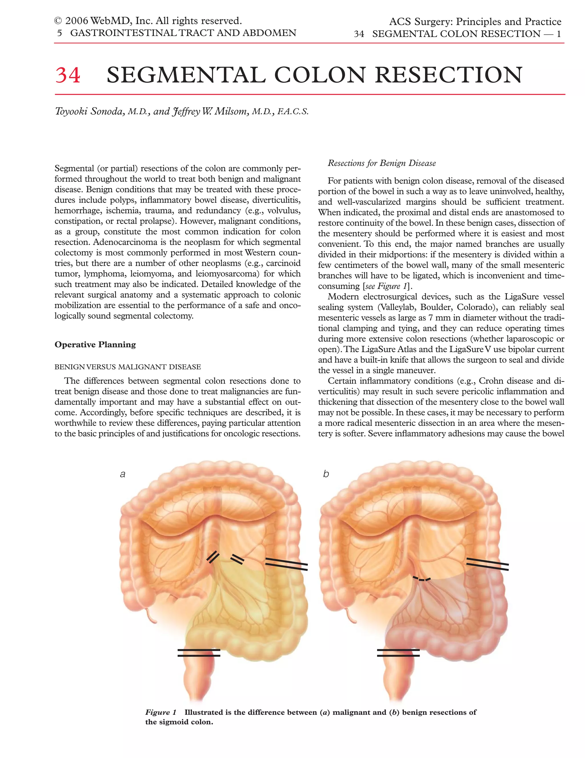 Acs0534 Segmental Colon Resection 2006 | PDF