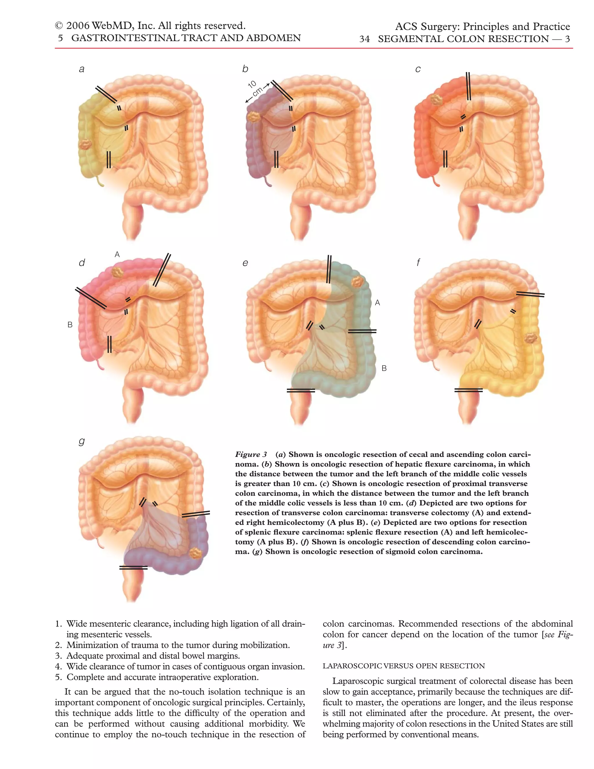 Acs0534 Segmental Colon Resection 2006 | PDF