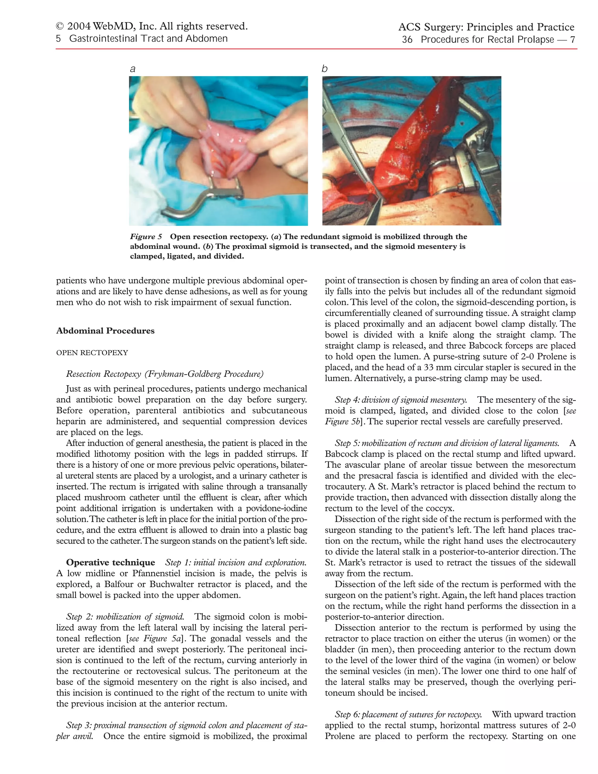 Acs0536 Procedures For Rectal Prolapse 2004 | PDF