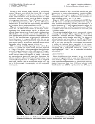 Acs0601 Stroke And Transient Ischemic Attack | PDF