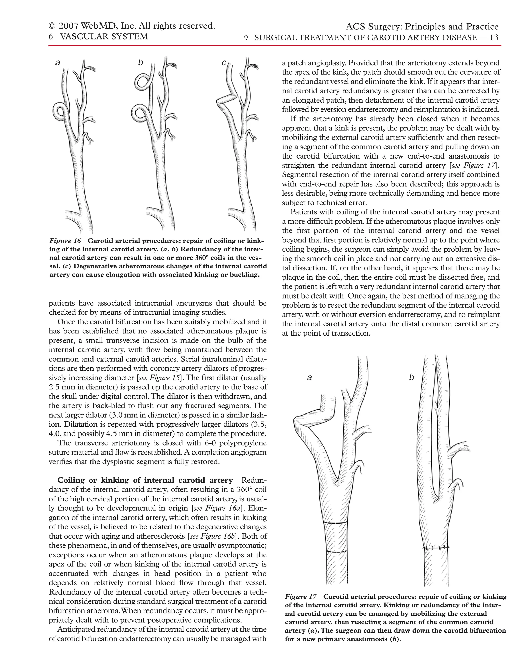 Acs0609 Surgical Treatment Of Carotid Artery Disease | PDF