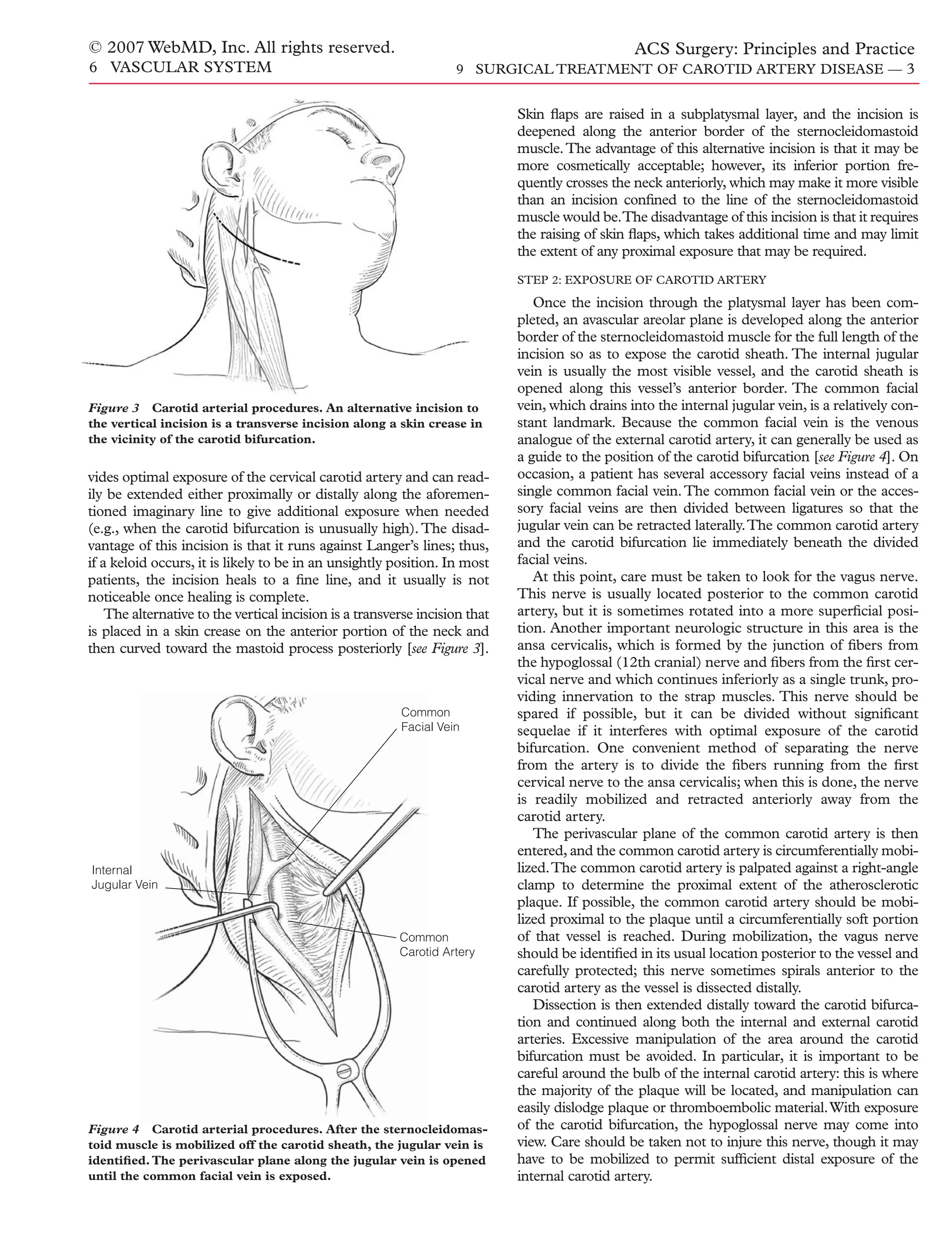 Acs0609 Surgical Treatment Of Carotid Artery Disease | PDF