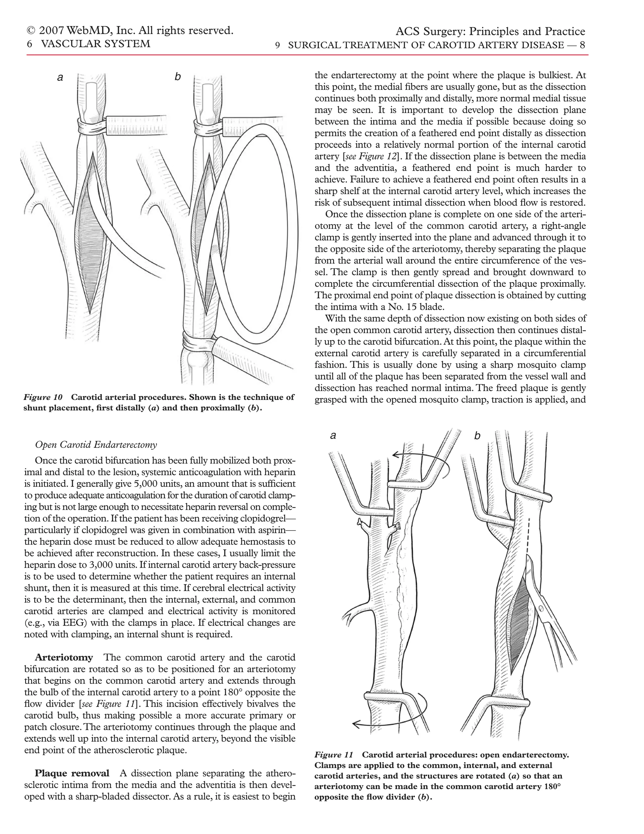 Acs0609 Surgical Treatment Of Carotid Artery Disease | PDF