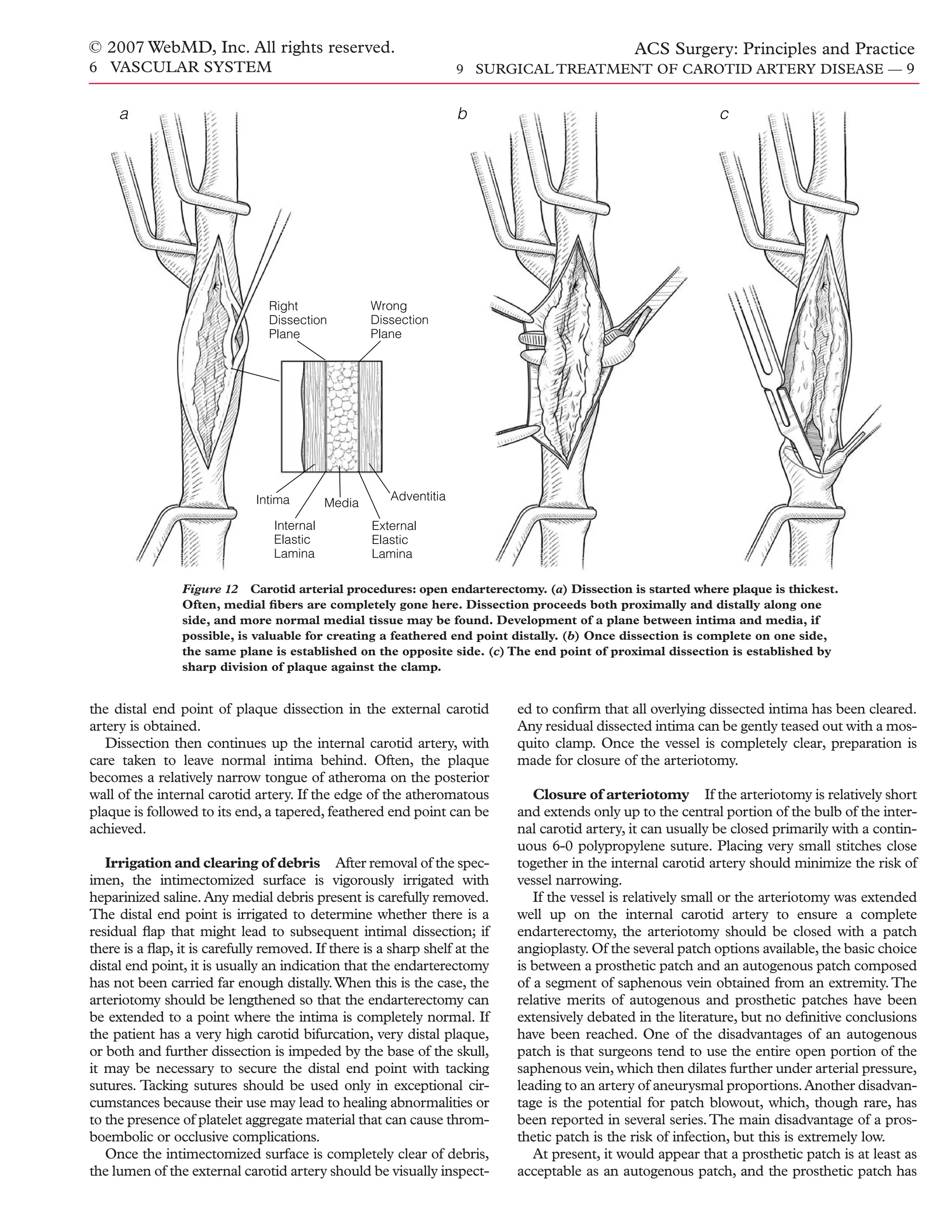 Acs0609 Surgical Treatment Of Carotid Artery Disease | PDF