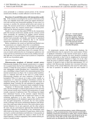 Acs0609 Surgical Treatment Of Carotid Artery Disease | PDF