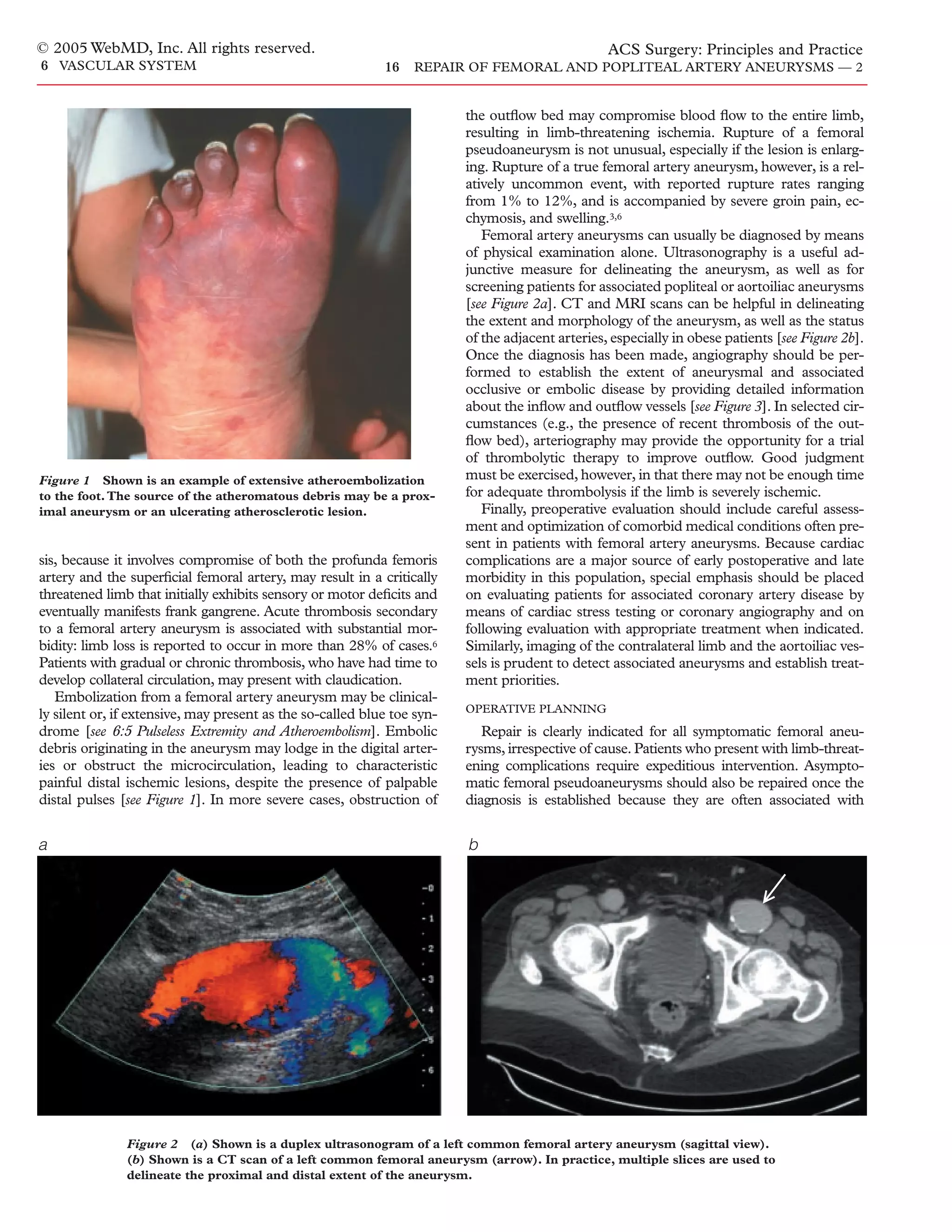 Acs0616 Repair Of Femoral And Popliteal Artery Aneurysms | PDF