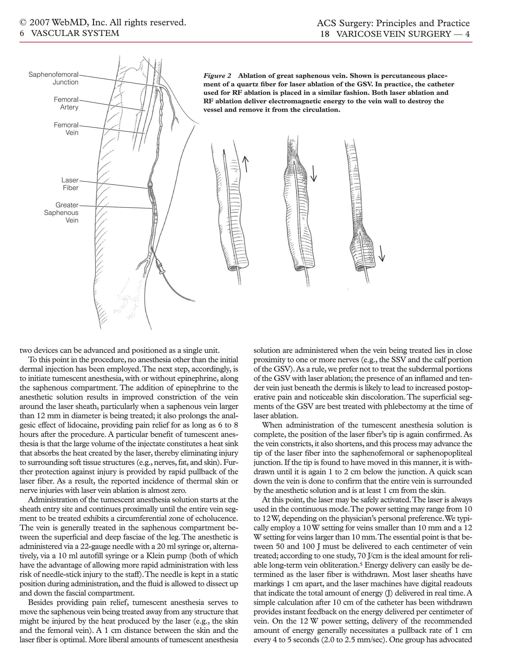 Acs0618 Varicose Vein Surgery | PDF