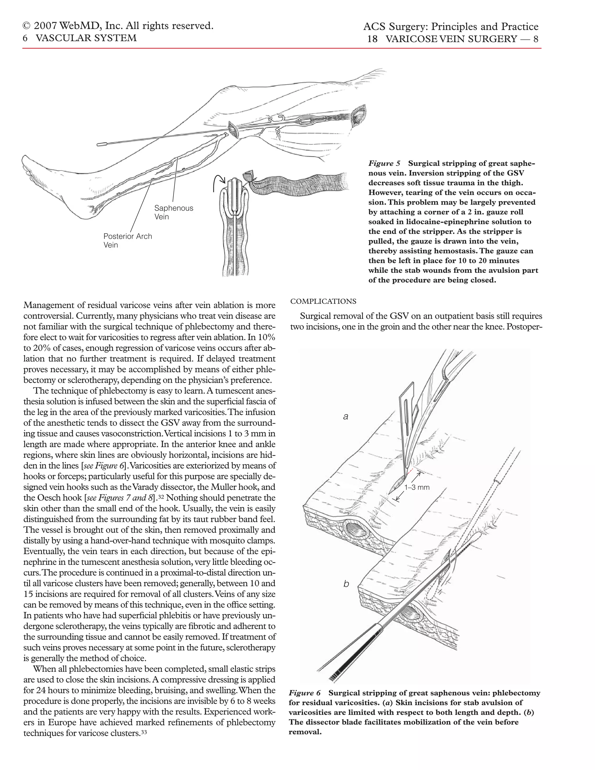 Acs0618 Varicose Vein Surgery | PDF