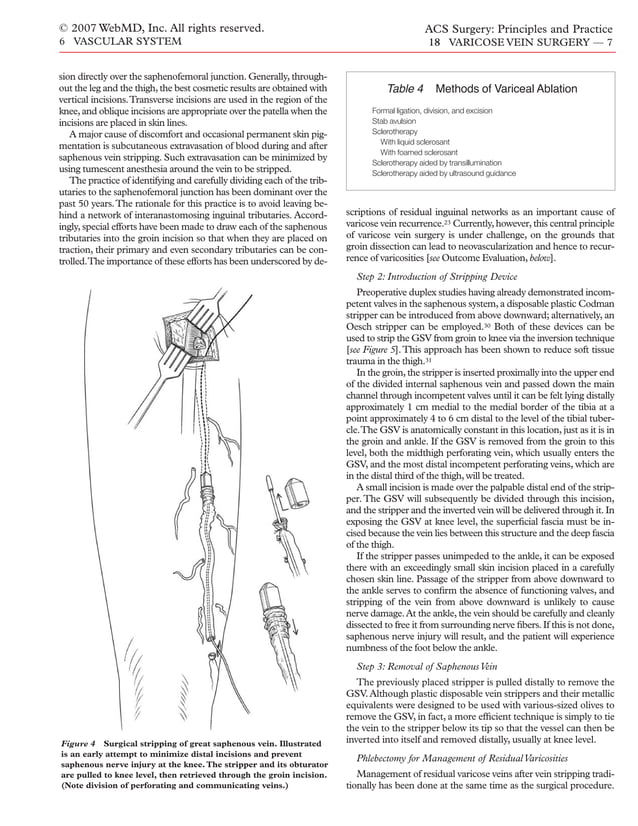 Acs0618 Varicose Vein Surgery | PDF