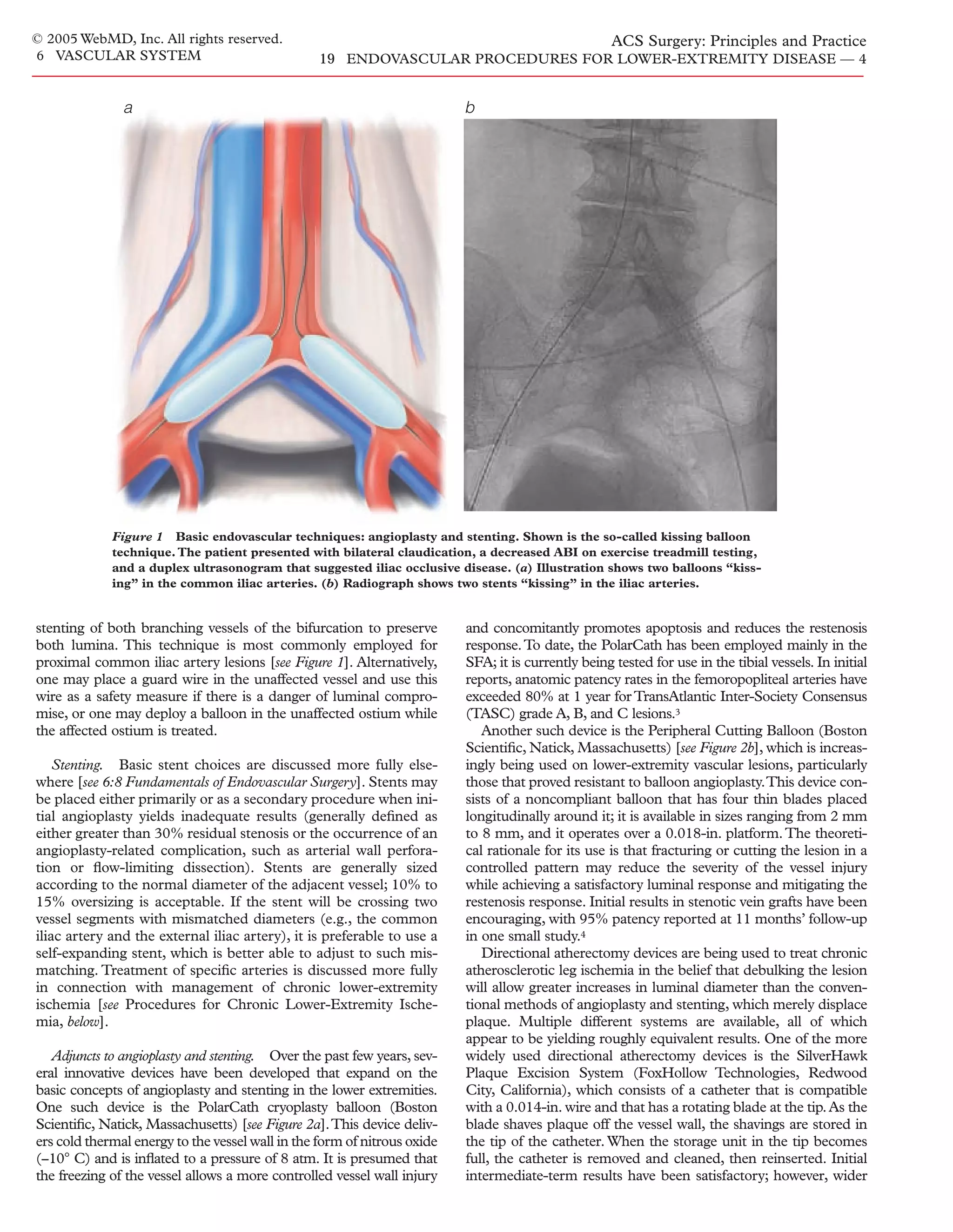 Acs0619 Endovascular Procedures For Lower Extremity Disease | PDF