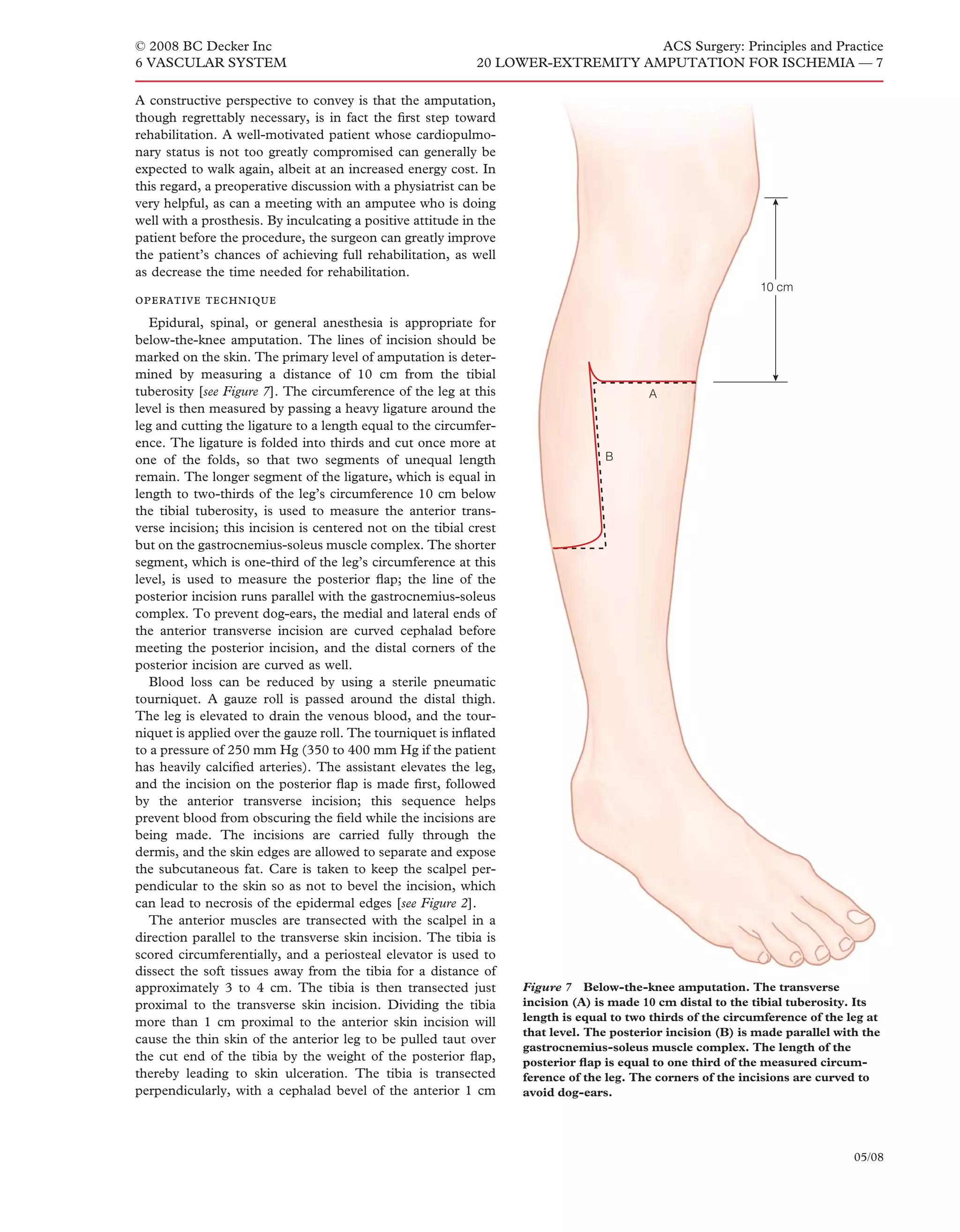 Acs0620 Lower Extremity Amputation For Ischemia | PDF
