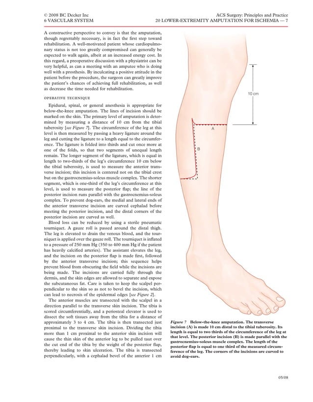 Acs0620 Lower Extremity Amputation For Ischemia | PDF