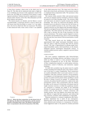 Acs0620 Lower Extremity Amputation For Ischemia | PDF