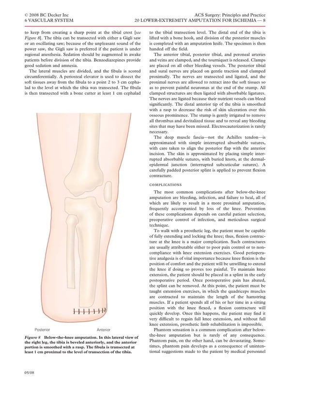 Acs0620 Lower Extremity Amputation For Ischemia | PDF