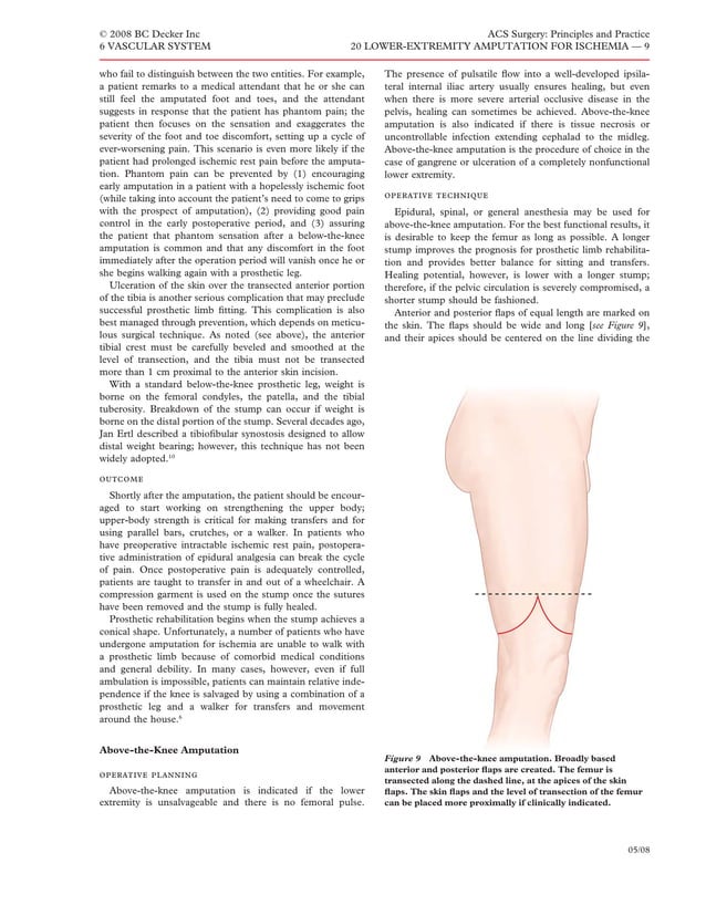 Acs0620 Lower Extremity Amputation For Ischemia | PDF