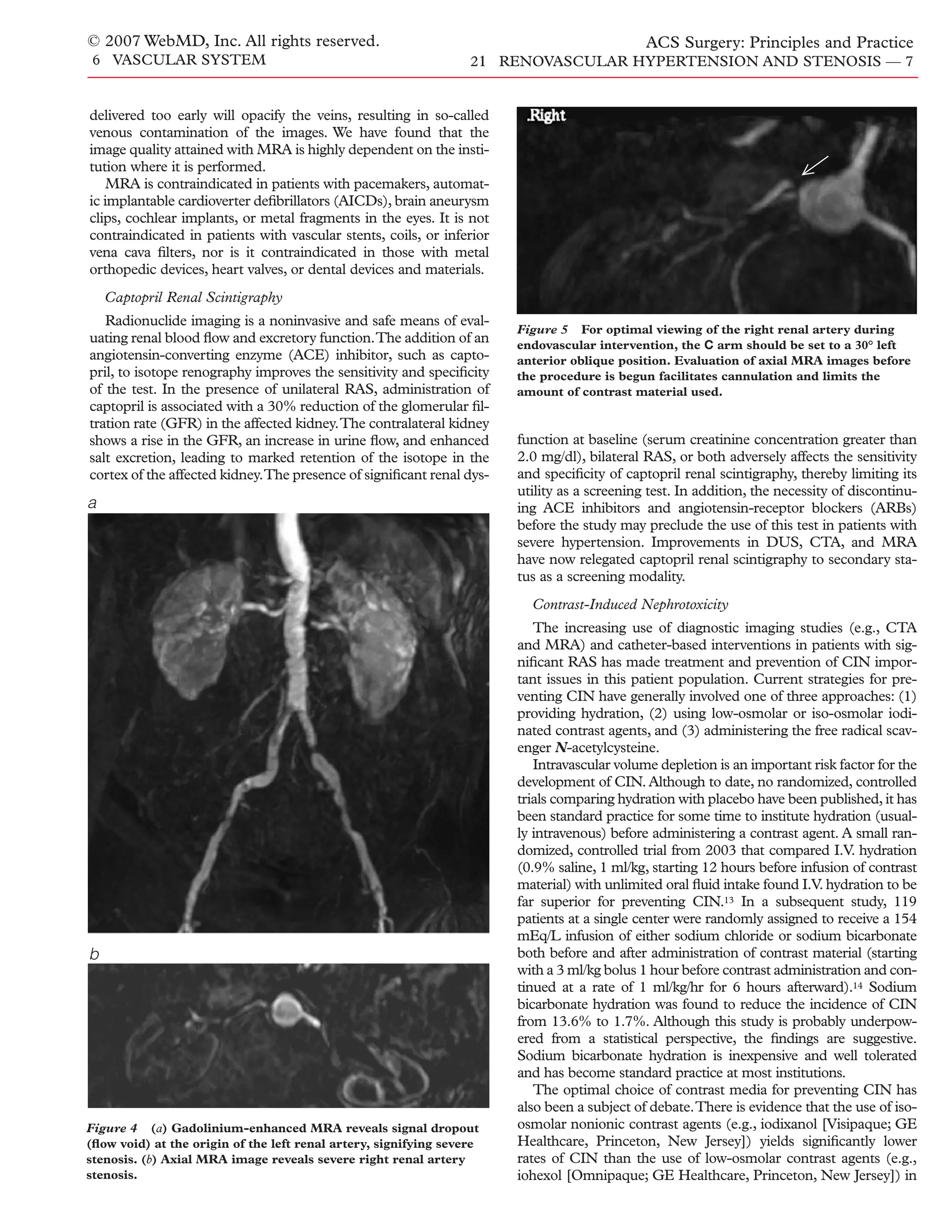 Acs0621 Renovascular Hypertension And Stenosis | PDF