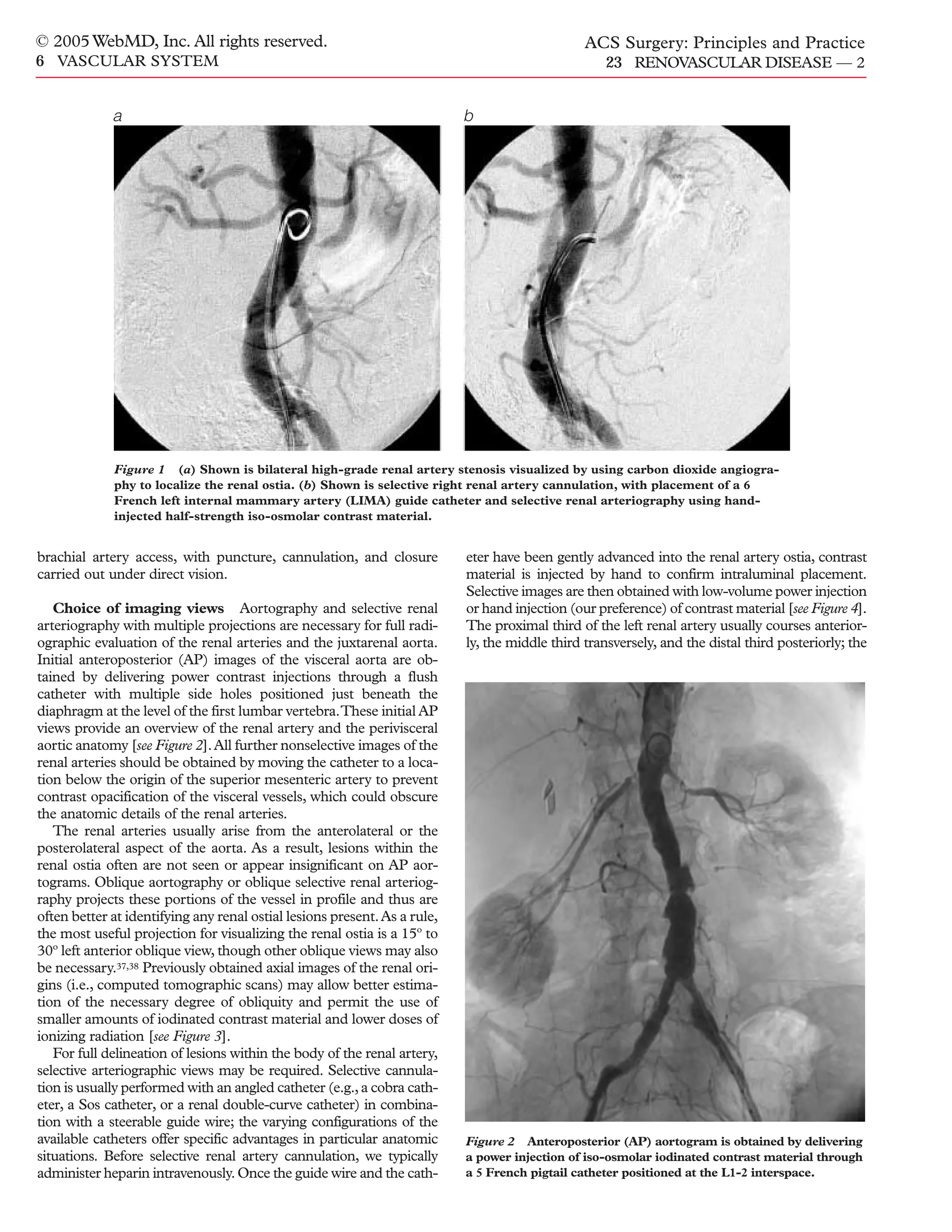 Acs0623 Endovascular Procedures For Renovascular Disease | PDF