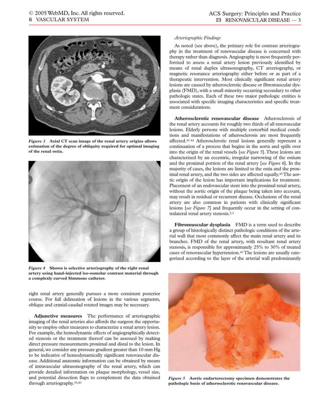 Acs0623 Endovascular Procedures For Renovascular Disease | PDF