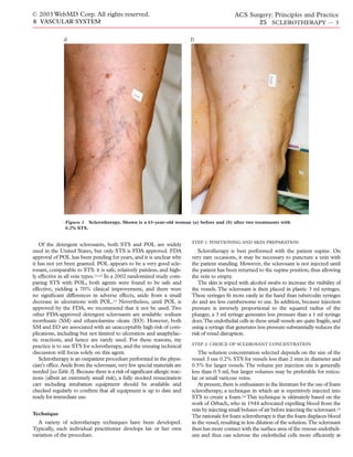 Acs0625 Sclerotherapy | PDF