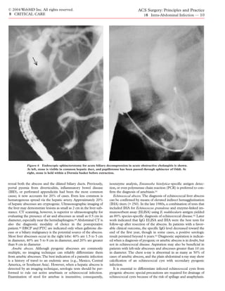 Acs0818 Intra Abdominal Infection | PDF