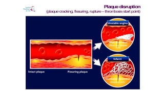 Acute MI and Unstable Angina / Coronary syndrome .pptx