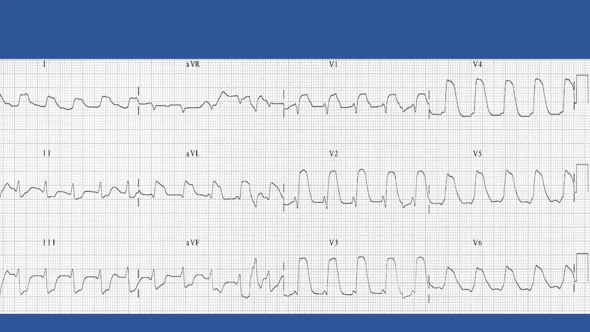 ACS and STEMI.pptx
