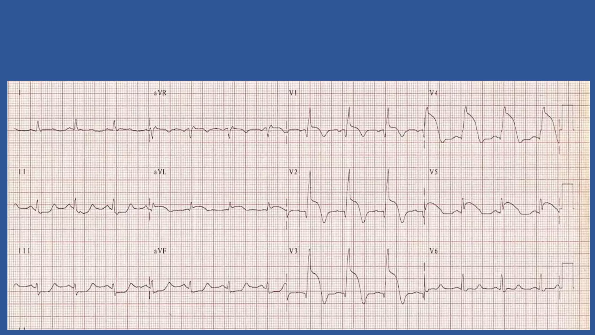 ACS and STEMI.pptx