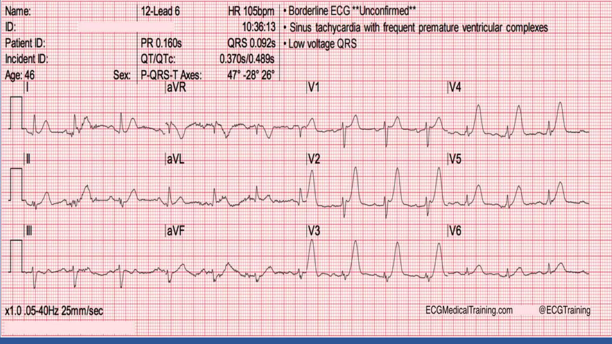 ACS and STEMI.pptx