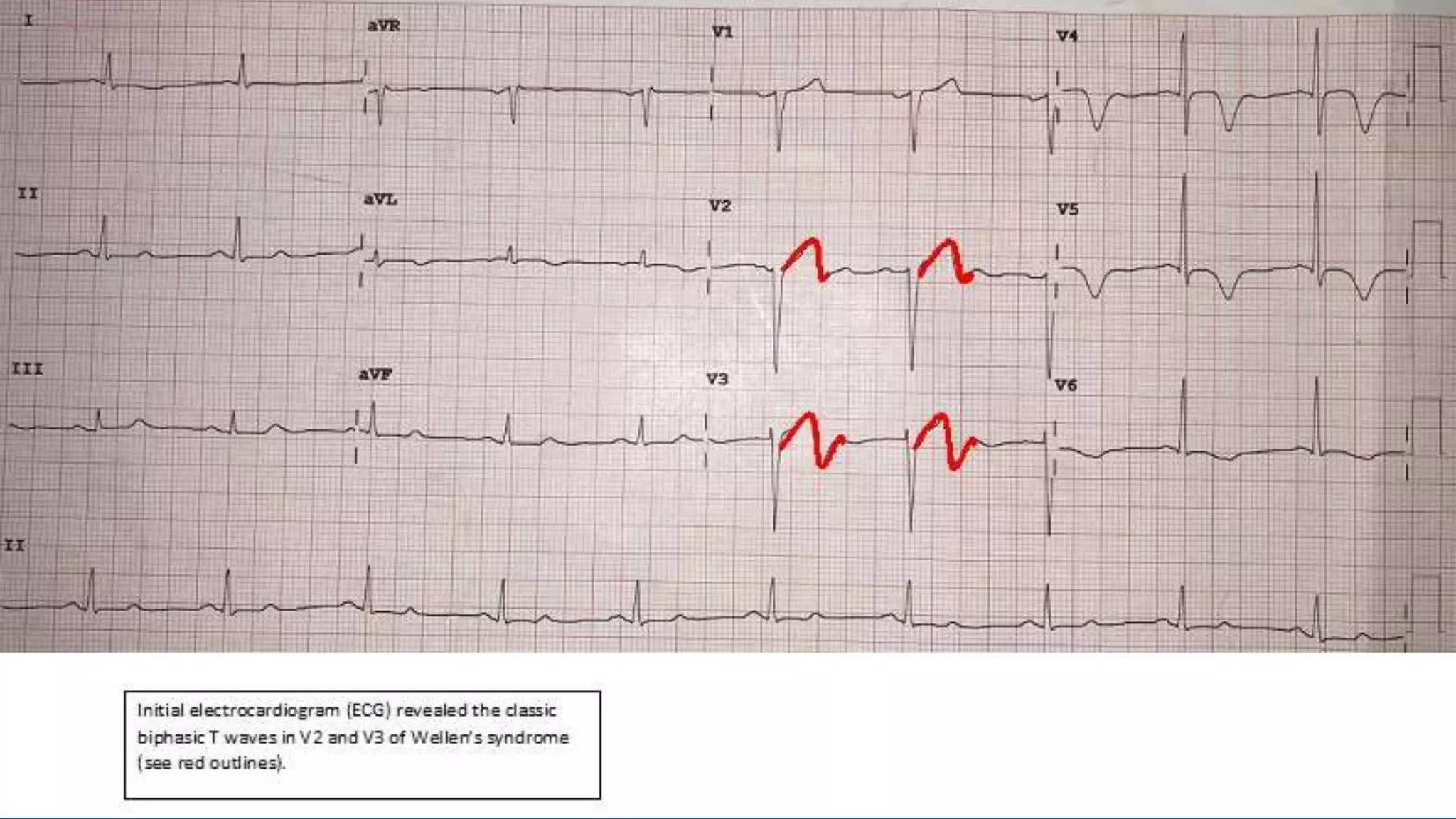 ACS and STEMI.pptx