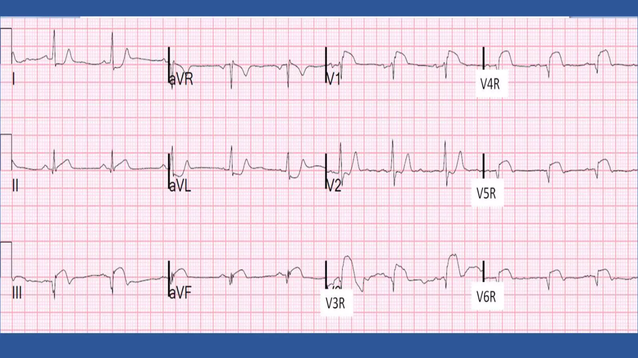ACS and STEMI.pptx