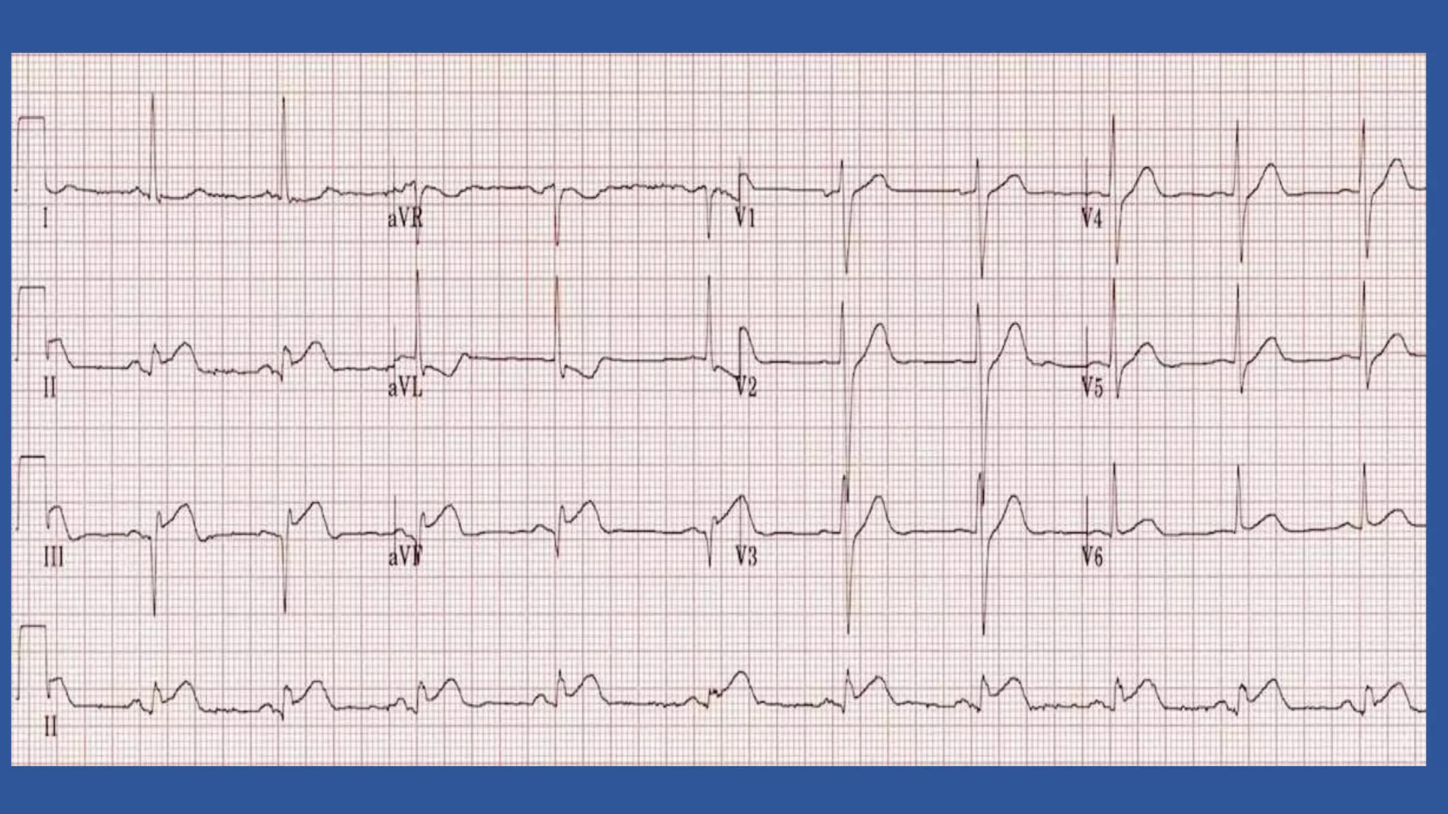 ACS and STEMI.pptx