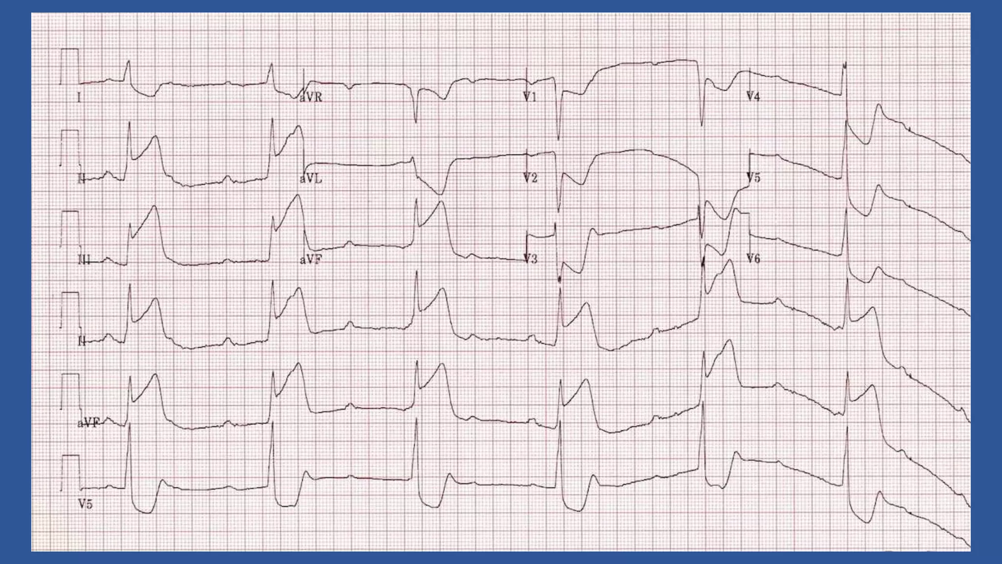 ACS and STEMI.pptx