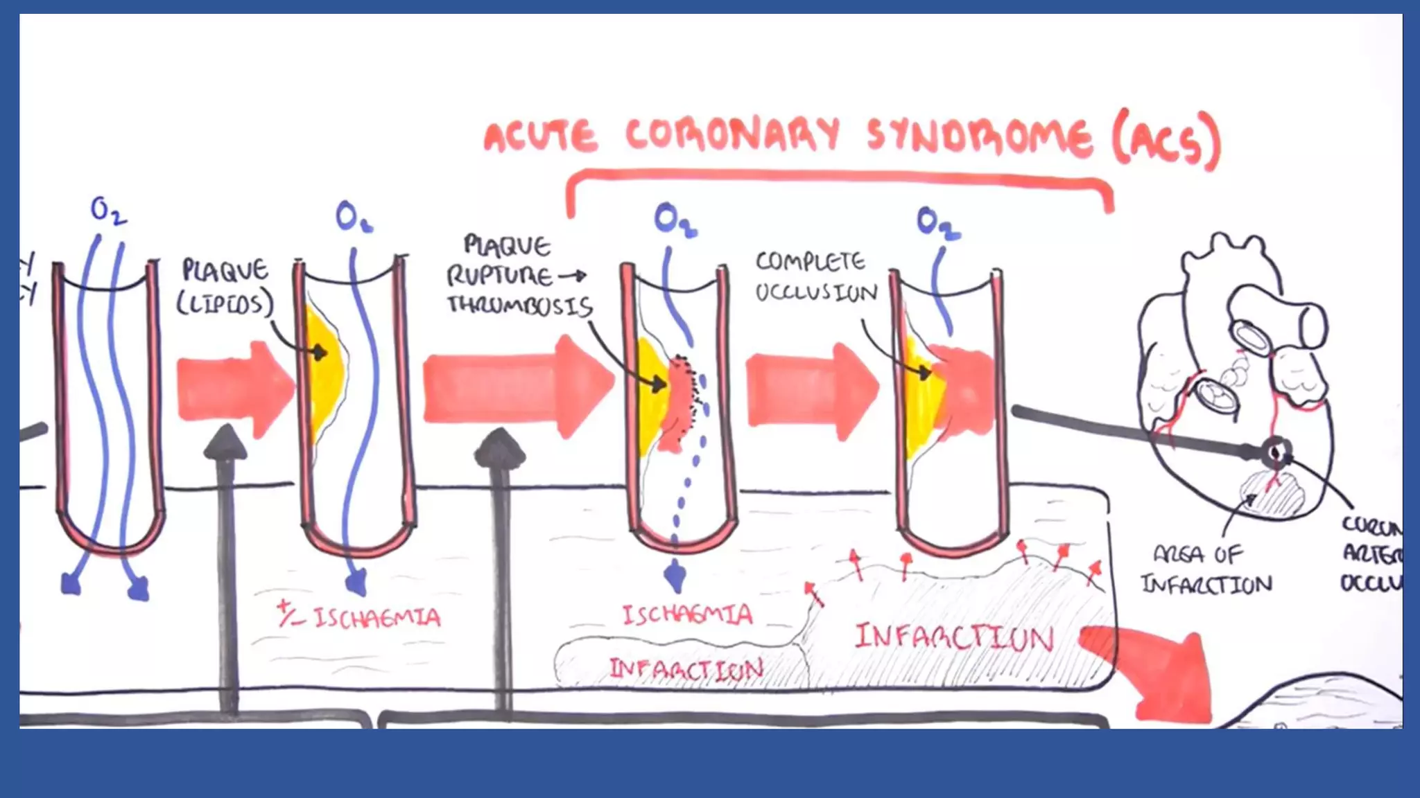 ACS and STEMI.pptx