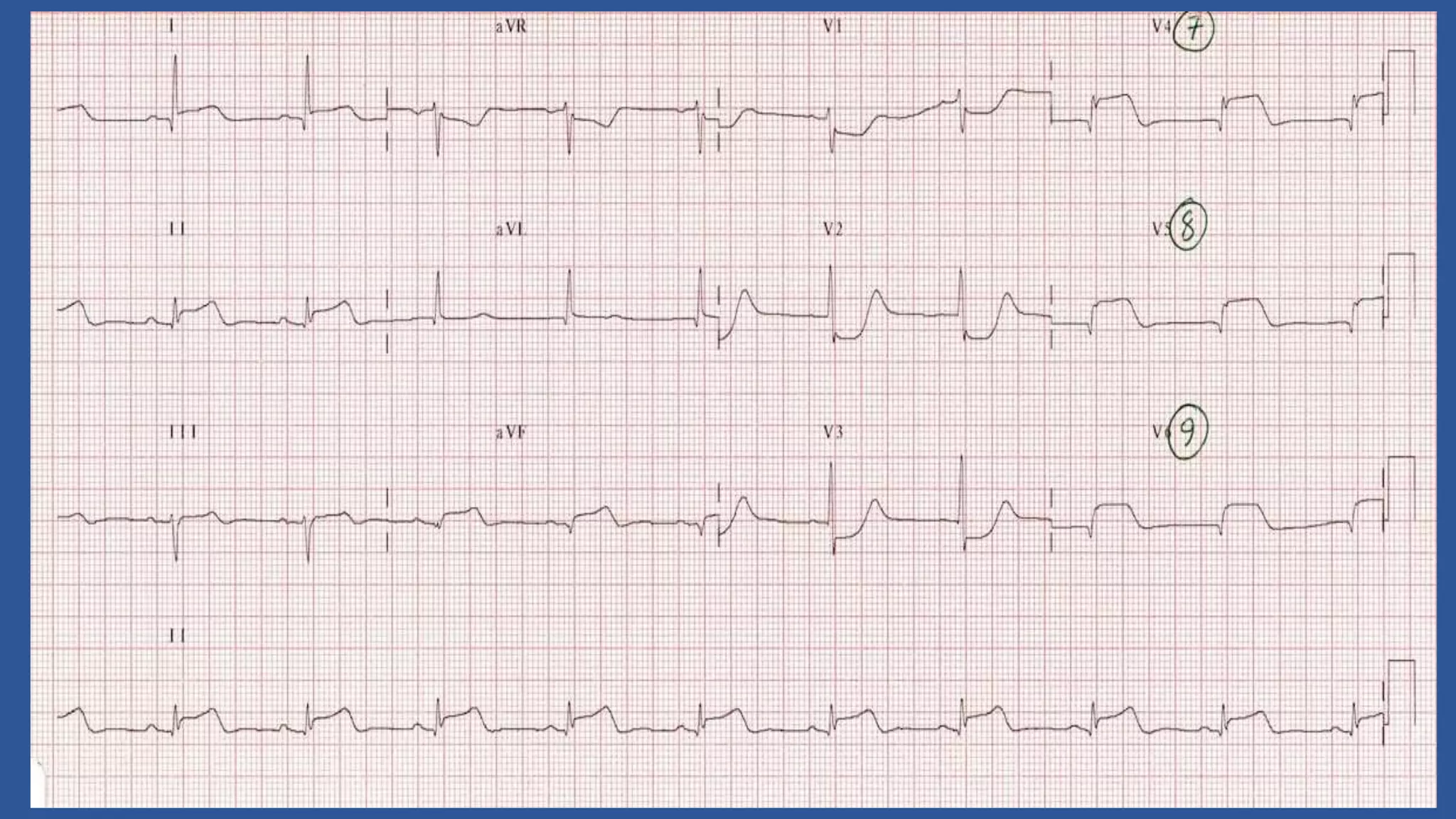 ACS and STEMI.pptx