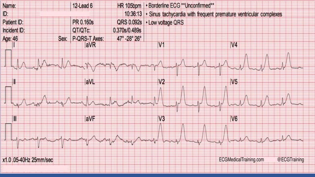 ACS and STEMI.pptx