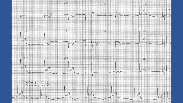 ACS and STEMI.pptx