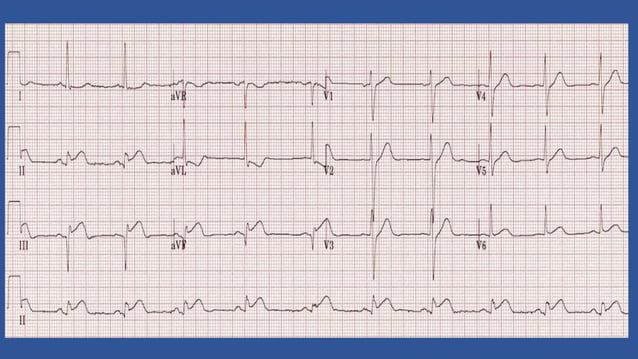 ACS and STEMI.pptx