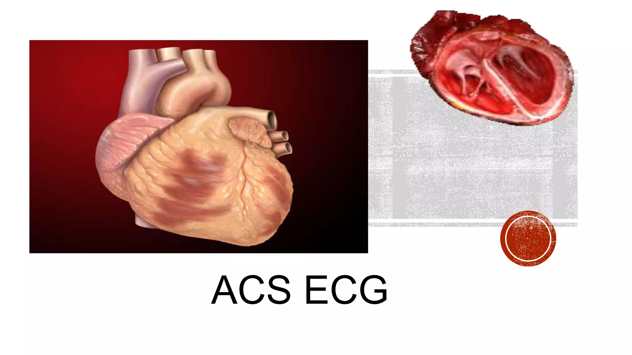Acs ecg | PPTX