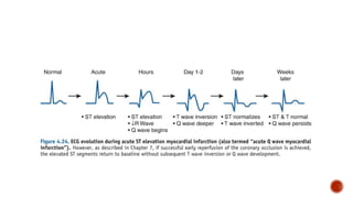 Acs ecg | PPTX | Heart and Cardiovascular Diseases | Diseases and ...