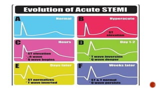 Acs ecg | PPTX | Heart and Cardiovascular Diseases | Diseases and ...